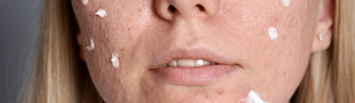 Benefits of Zinc Oxide Calamine for Acne Care